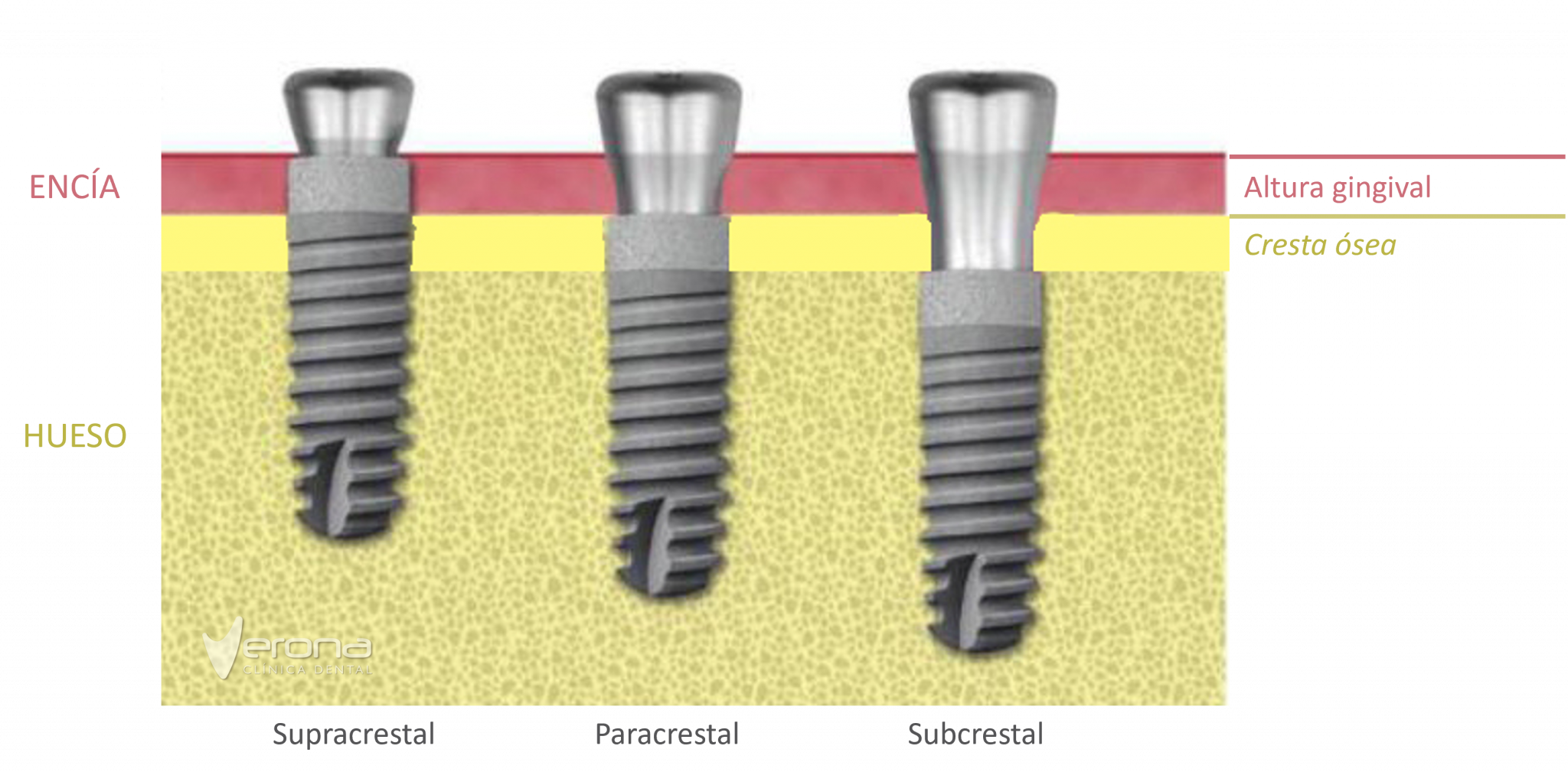 Implantes dentales • Clinica Verona